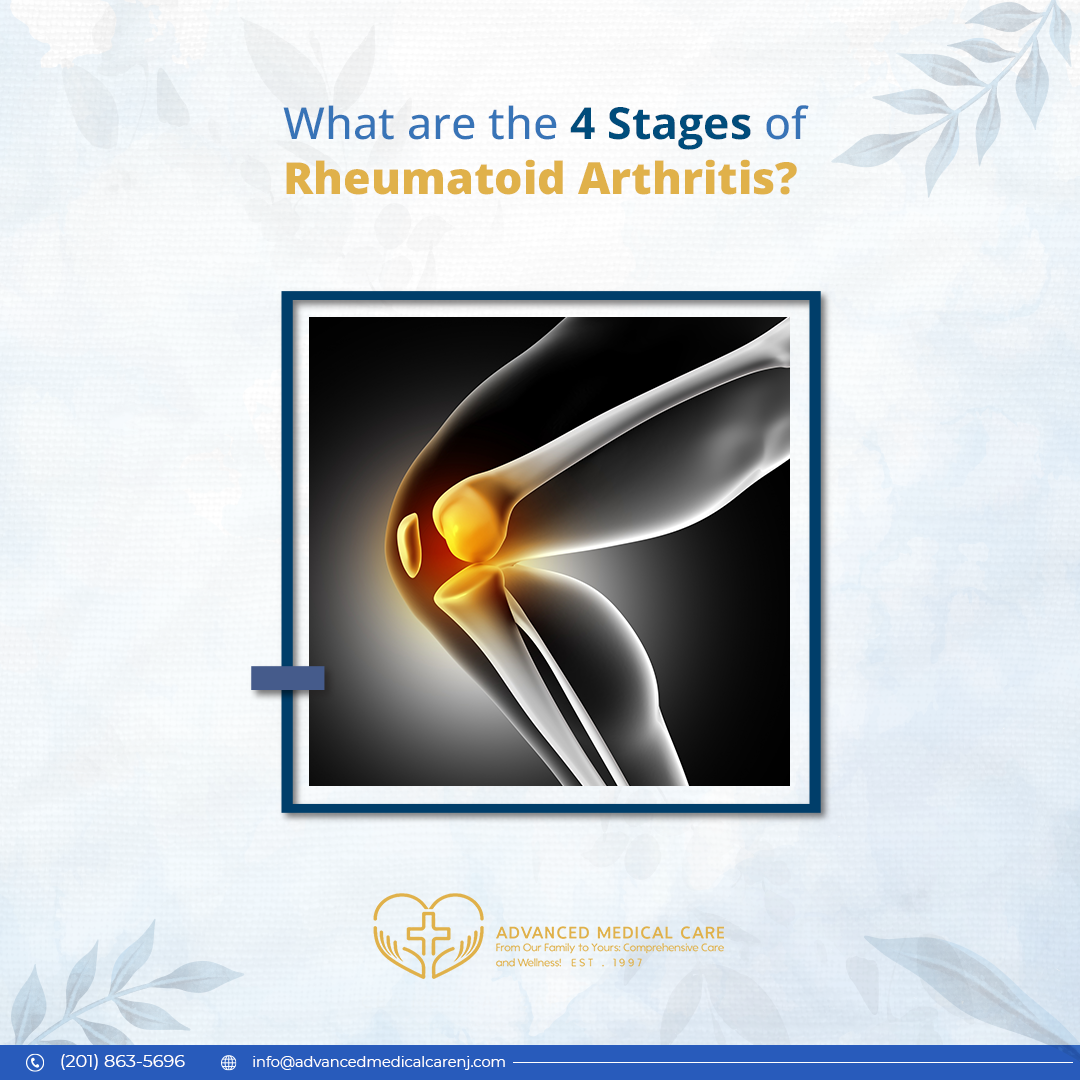 What Are the 4 Stages of Rheumatoid Arthritis?